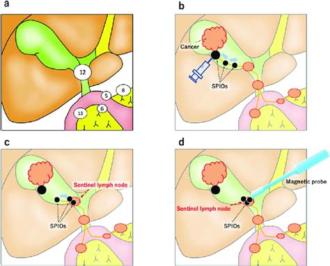 Regional Lymph Node Map For Gallbladder Cancer And The Procedure For Download Scientific