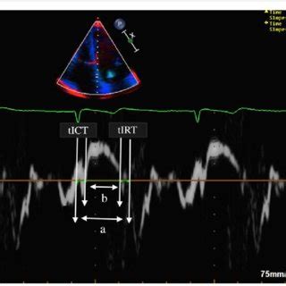 Myocardial Performance Index Measured By Tissue Doppler Imaging Time Download Scientific
