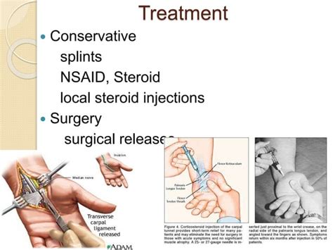 Peripheral Nerve Compression Syndrome Peripheral Nerve Compression Syndrome