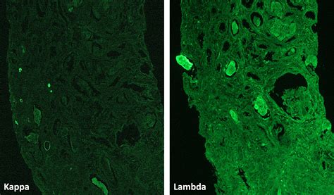 Pathology Outlines Kappa And Lambda Light Chains