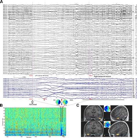 A Simultaneous Meg And Eeg Recording Of A Right‐sided Pilomotor Download Scientific Diagram