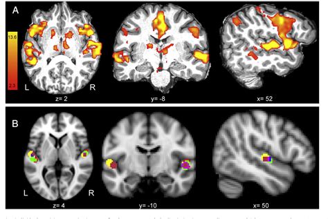 Auditory Cortex Mri