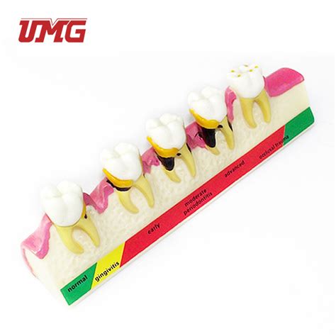 China Periodontal Diseases Classification Teeth Model China Teeth Model Dental Training Models