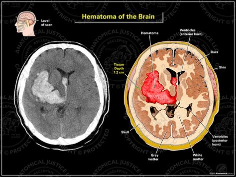 Hematoma Of The Brain