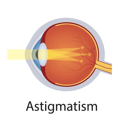 Astigmatism And Vision Disorders Illustration Eyes Defect Concept