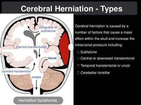 Herniation Syndromes