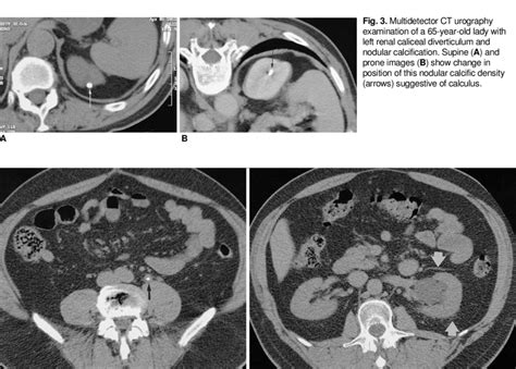 Unenhanced Multidetector Ct Urography In A 46 Year Old Man With Download Scientific Diagram