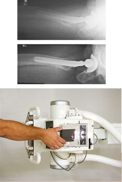 Compensating Filters Radiology Key