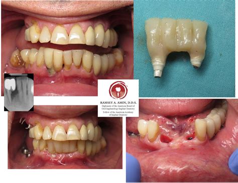 Lower Front Dental Implants With Gum Graft And Immediate Temporaries