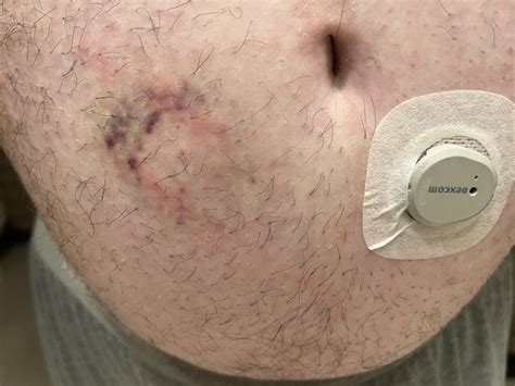 Rash Solution For Those Also Allergic To Skin Tac Rdexcom