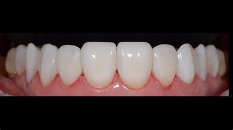 Flowable Injection Technique A Flowable Composite