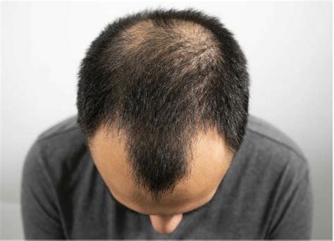 Androgenetic Alopecia Symptoms Causes And Prevention