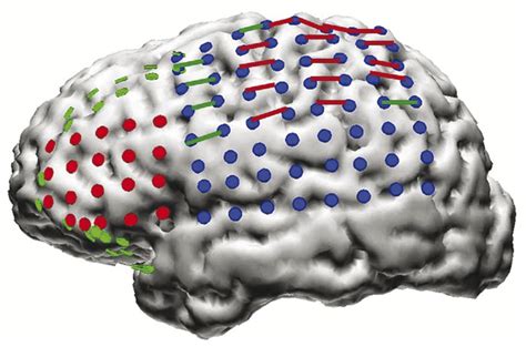 7 Extraoperative Mapping For Epilepsy Surgery Epilepsy Monitoring Wada And