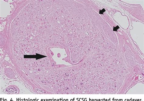 Superior Cervical Ganglion Cadaver