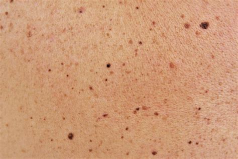 How To Self Examine Your Moles According To An Expert