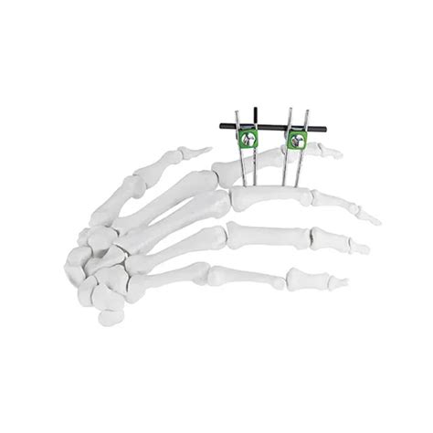 Orthopedic External Fixation For Distal Radius Fractures External Fixator Kit Distal Radius