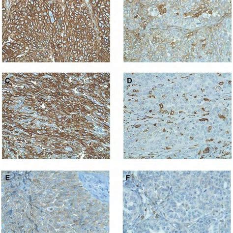Immunohistochemical Analysis Of High Grade Serous Eoc Tumors Showing