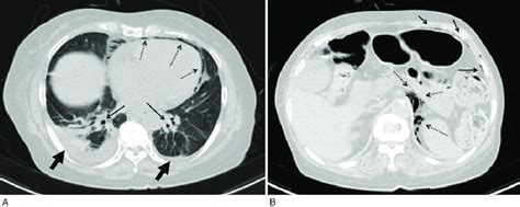 Chest Ct A Showed Pneumopericardium And Pneumomediastinum Along The