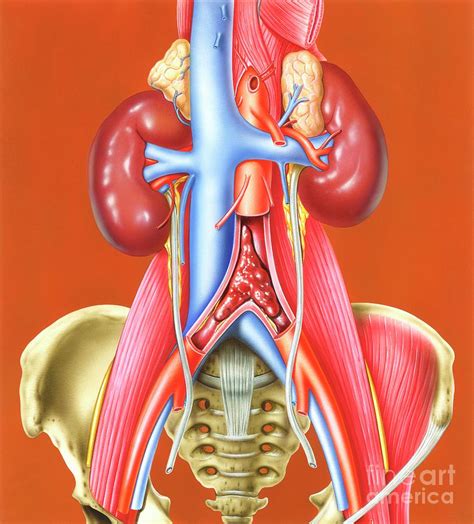 Saddle Embolus At Aortic Bifurcation Photograph By John Bavosiscience