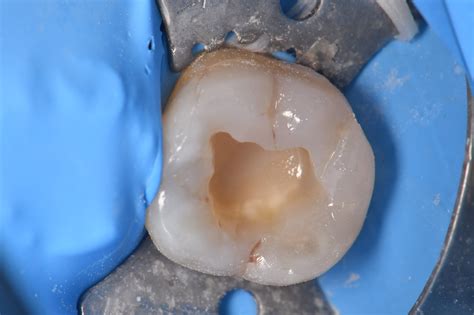 Short Fiber Reinforced Composite Endodontic Access Restoration