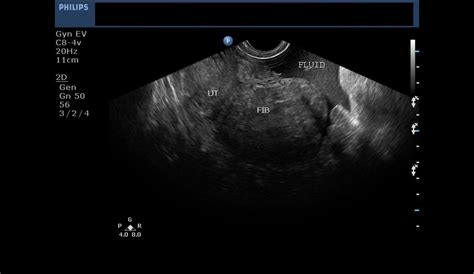 Ultrasound Imaging Fibroid Complicating A Possible Ectopic Gestation