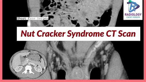 Nutcracker Syndrome Ct Diagnosis At Morris Rios Blog