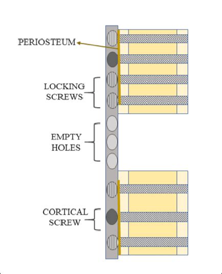 Locking Compression Plate Fixation Of A Segmental Tibial Bone Defect Download Scientific Diagram
