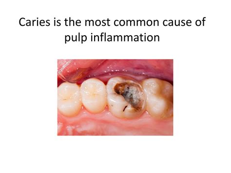Solution Chronic Pulpitis Studypool