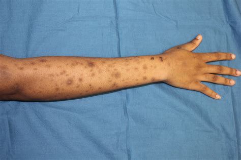 Post Inflammatory Hyperpigmentation Digital Dermatology Atlas