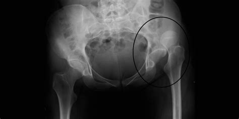 Who And Why Risks Dislocation After Hip Arthroplasty Orthopedics This Week