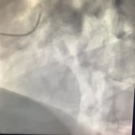 Saeed Amiripouya On Linkedin Lad Total Occlusion Retrograde Injection Wire Pilot 50 Stent Xience…