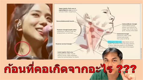 คนดังกับโรค จีซู Black Pink ก้อนที่คอโต เกิดจากสาเหตุอะไร Youtube