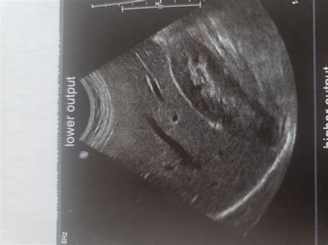 Pulsed Echo Instrumentation Flashcards Quizlet