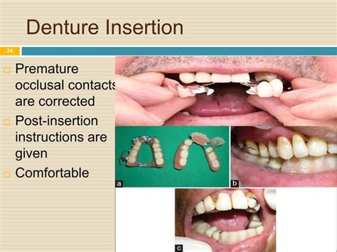 Steps Of Fabrication Of Removable Partial Denture PPTX Oral Care Personal Care