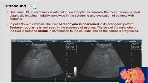 Diffuse Liver Diseases And Their Appearance In Ultrasound Pptx