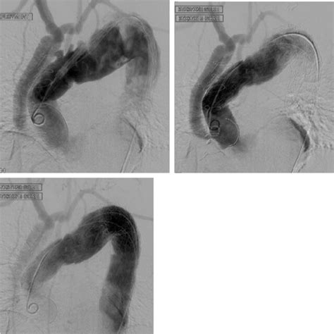 Surface Shading Reconstruction From Ct Angiogram A Thoracic Aortic