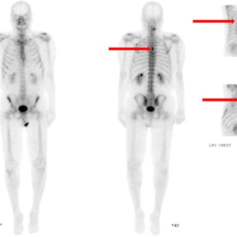 Whole Body 99 Tm Bone Scan Demonstrating Non Specific Activity In The Download Scientific
