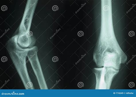 X Ray Radiography Stock Image 774349