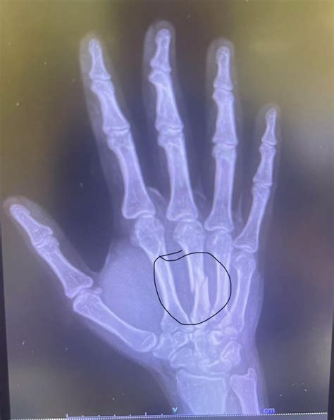 Nail Or Splint For Metacarpal Fracture Rbrokenbones