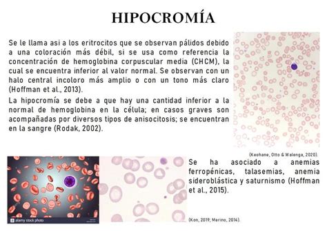 HipocromÍa En 2023 Eritrocitos