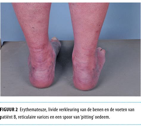 What Is Acrodermatitis Causes Symptoms And More