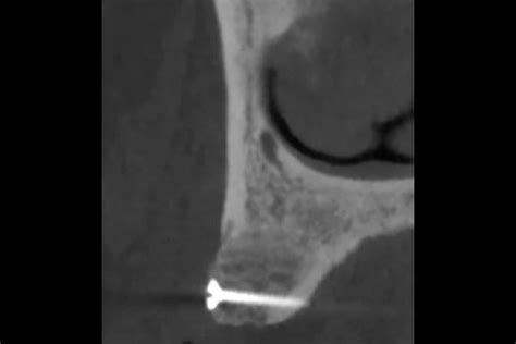 Lateral Block Augmentation In The Posterior Maxilla With Cancellous Maxgraft® Block Botiss