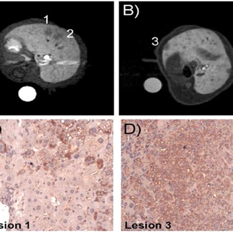 Histological Validation Of Mri Lesion Detection T1 Weighted Mr Images