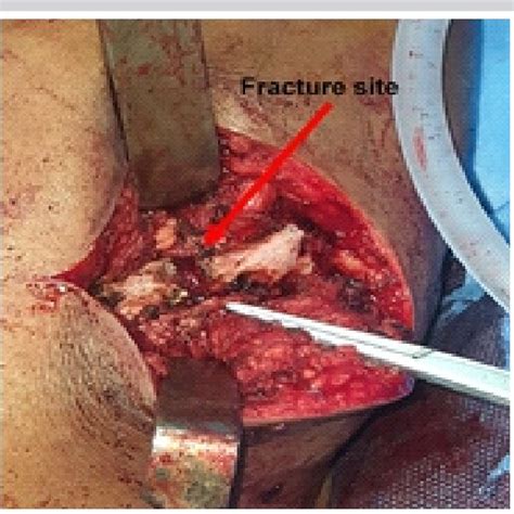 Intraoperative Picture Showing The Fracture Site In The Acromion