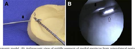 Figure 2 From Outside In Singlelasso Loop Technique For Meniscal