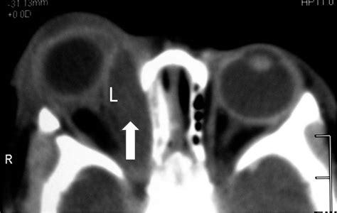 Orbital Cellulitis Ct Scan Findings Ct Scan Machine Images And Photos Finder