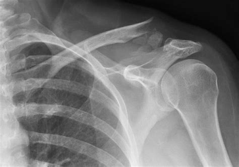 Technique Spotlight Arthoscopic Assisted Reduction And Internal Fixation Of Distal Clavicle