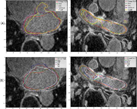 Figure 9 From Semi Supervised Unpaired Medical Image Segmentation Through Task Affinity
