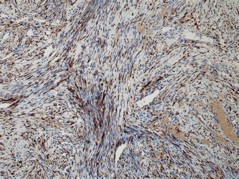 Biphenotypic Sinonasal Sarcoma Rare Sarcoma Of The Nasal Tract Which