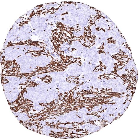 Cancer Tissue Gallery Gtx640564 Genetex